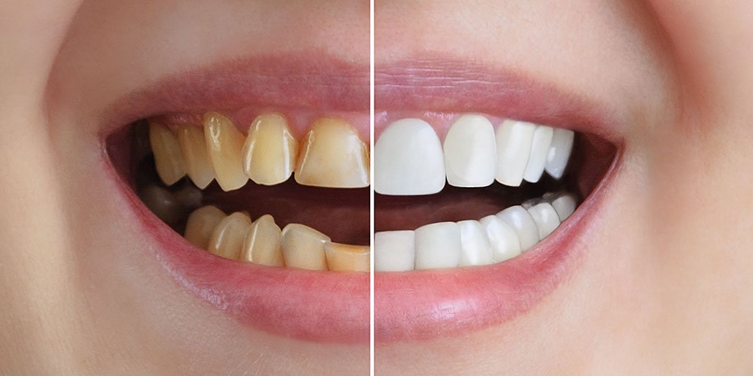 Facetas em resina composta – Studio Orofacial